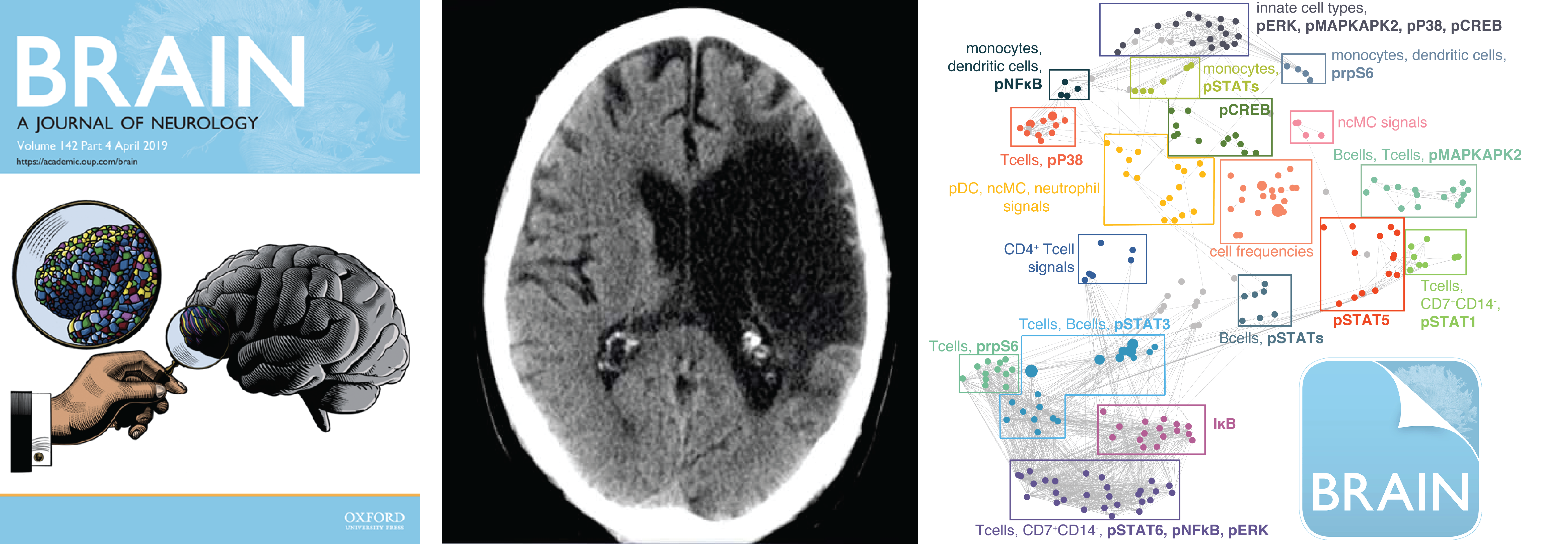 A year-long immune profile of the systemic response in acute stroke ...